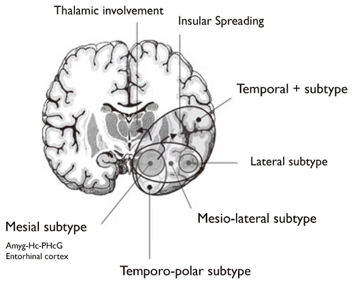 Temporal Lobe Epilepsy - Long-term Management Of Children With Epilepsy